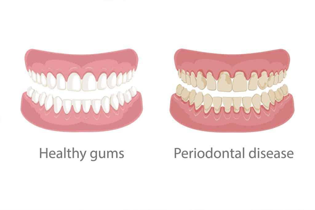 4 Common Signs of Periodontal (Gum) Disease | Smile Shack